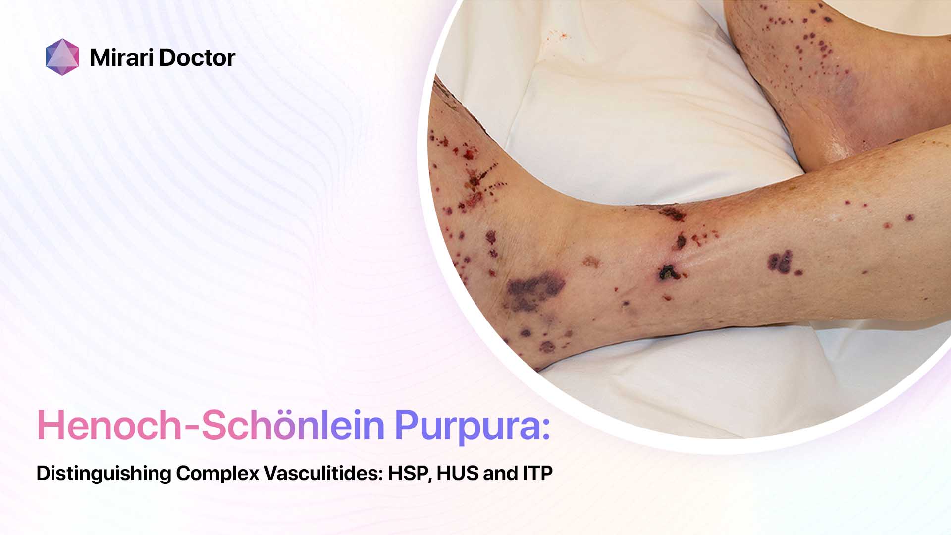 Distinguishing Complex Vasculitides: HSP, HUS and ITP
