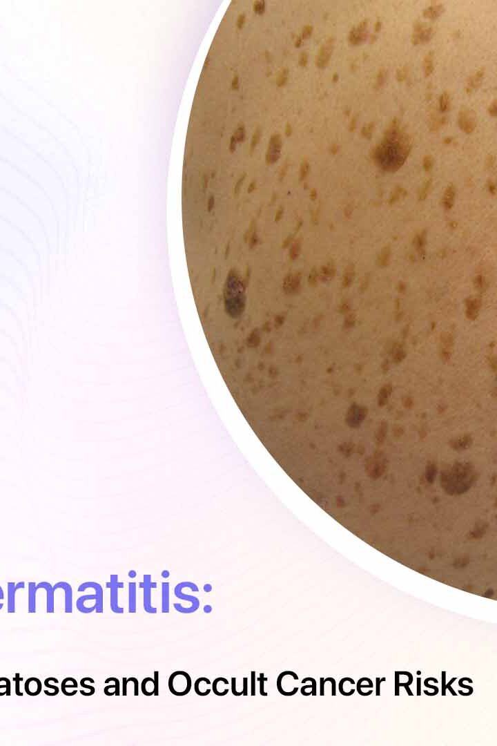 Decoding Connections Eruptive Seborrheic Keratoses And Occult Cancer Risks