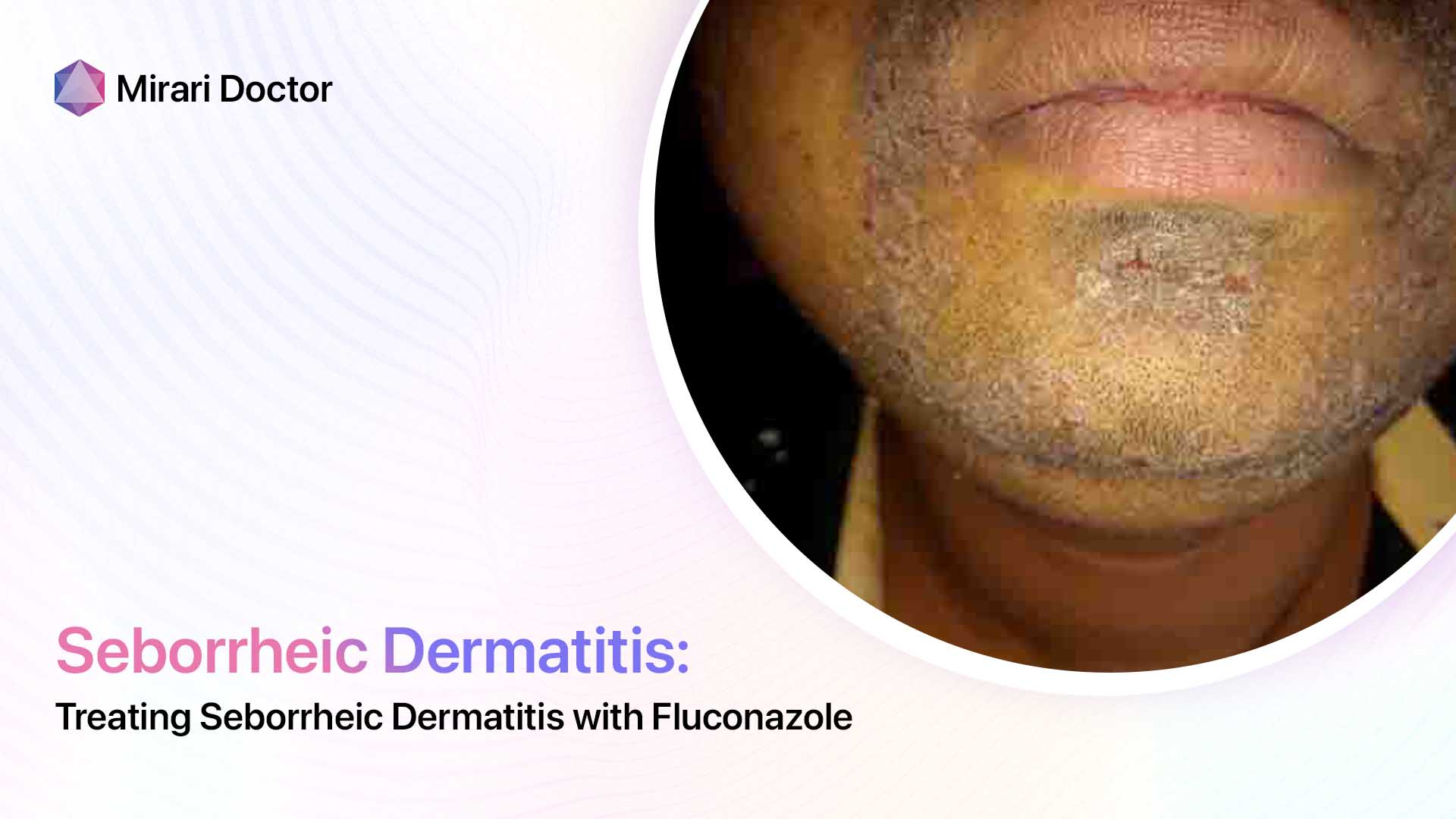 Mirari Doctor - Treating Seborrheic Dermatitis with ...