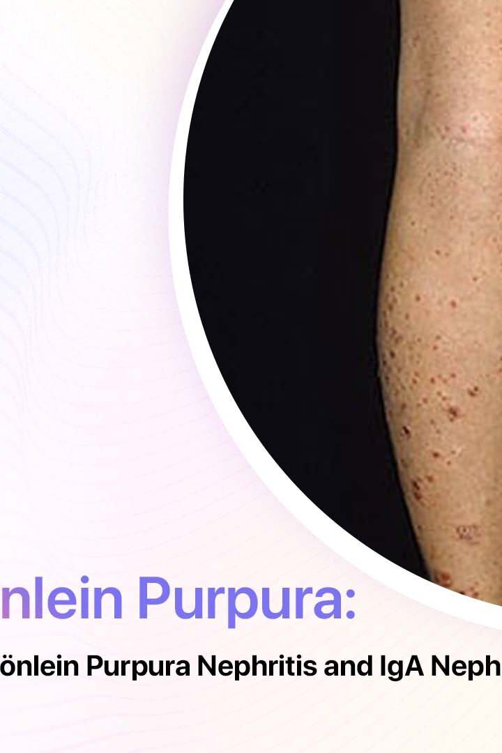 The Overlap of Henoch-Schönlein Purpura Nephritis and IgA Nephropathy