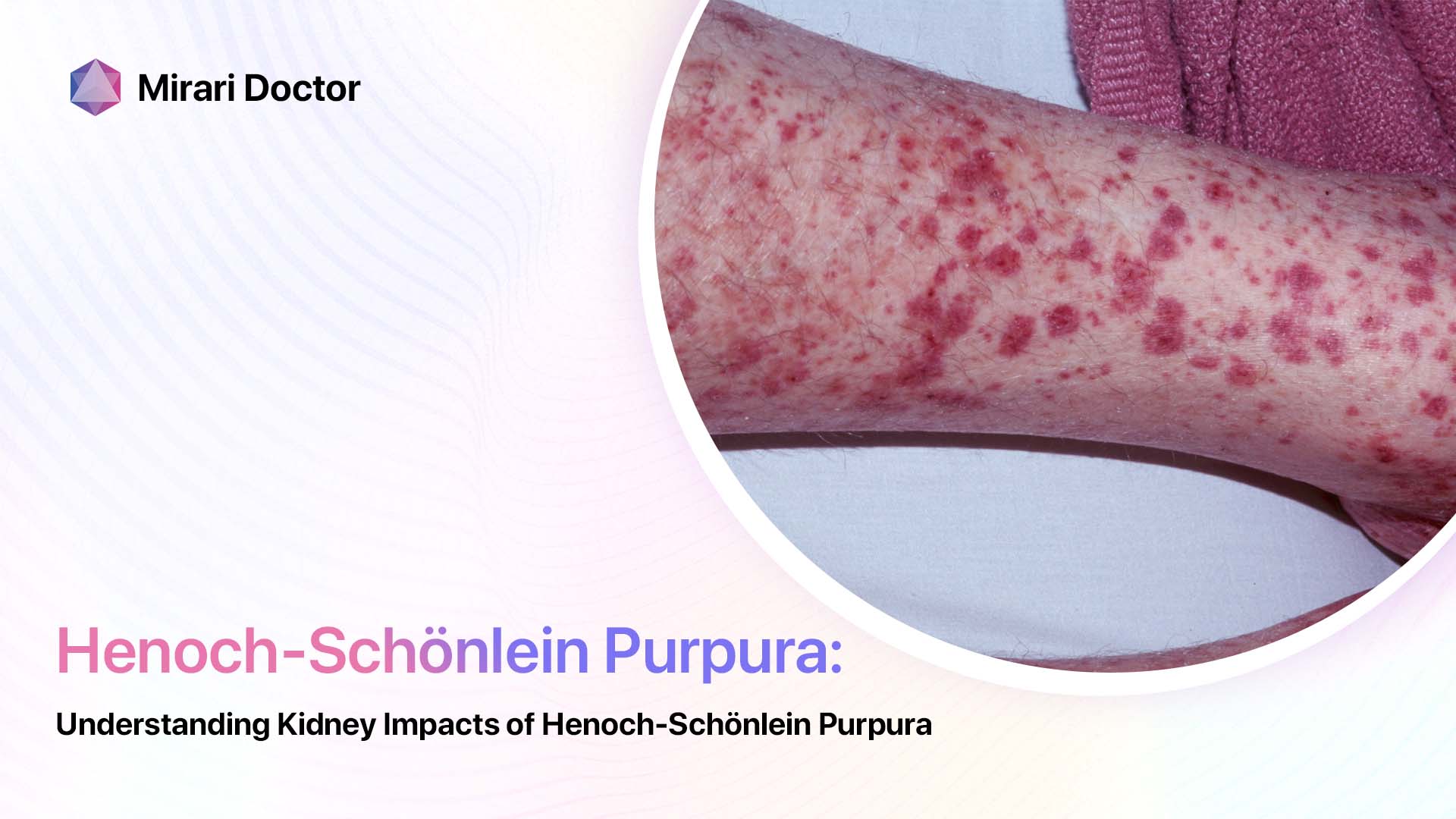 Understanding Kidney Impacts of Henoch-Schönlein Purpura
